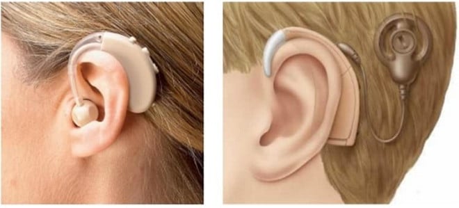 Entenda como funciona o Implante Coclear