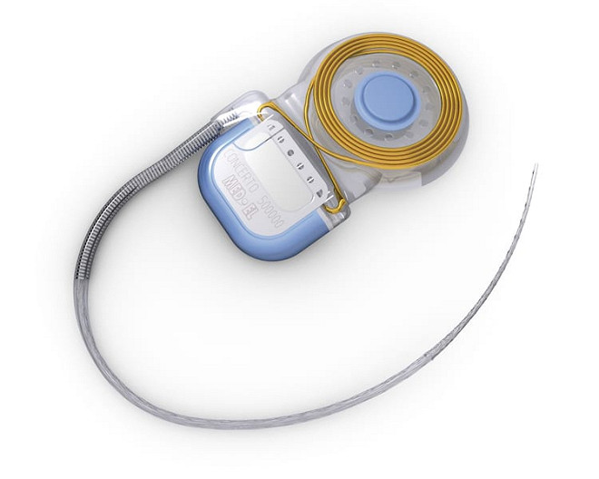 Entenda como funciona o Implante Coclear